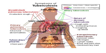 Tuberculosis (TB): Causes, Symptoms, and Treatments - Zoefact