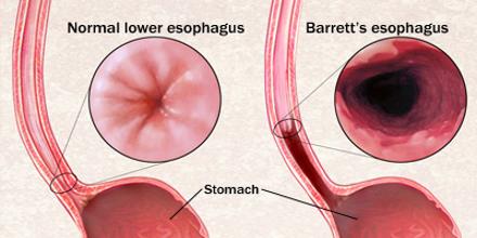 Barrett's Esophagus: Causes and Treatment - Assignment Point