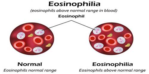 Eosinophilia - Assignment Point