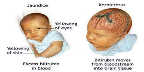 Kernicterus - Assignment Point