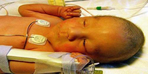 Kernicterus - Assignment Point