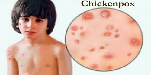 Chickenpox (Diagnosis, Treatment, and Preventions) - Assignment Point