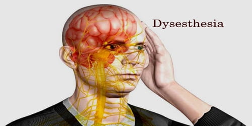 Dysesthesia - Assignment Point