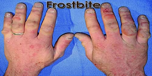 Frostbite Meaning