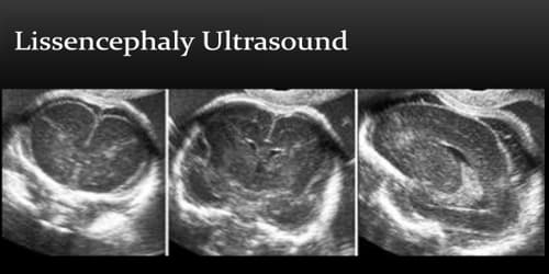 Lissencephaly Mri Lissencephaly | Radiology Case | Radiopaedia.org