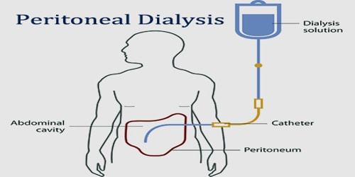 Peritoneal Dialysis - Assignment Point
