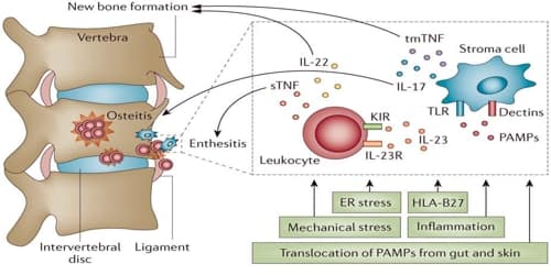 Axial spondyloarthritis - Assignment Point