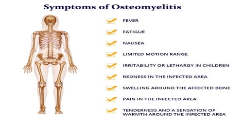 Osteomyelitis (Symptoms, Diagnosis, and Treatment) - Assignment Point