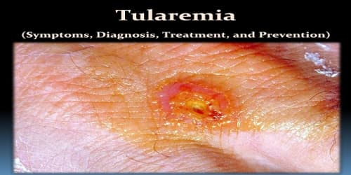 Tularemia (Symptoms, Diagnosis, Treatment, and Prevention) - Assignment ...